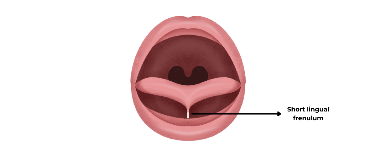 Understanding Tongue-Tie As a Parent