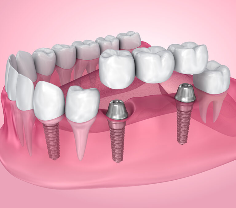 Dental Bridge Singapore - Menutup Kesenjangan & Mengganti Gigi yang Hilang