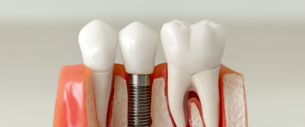 A Comprehensive Guide to Dental Implants