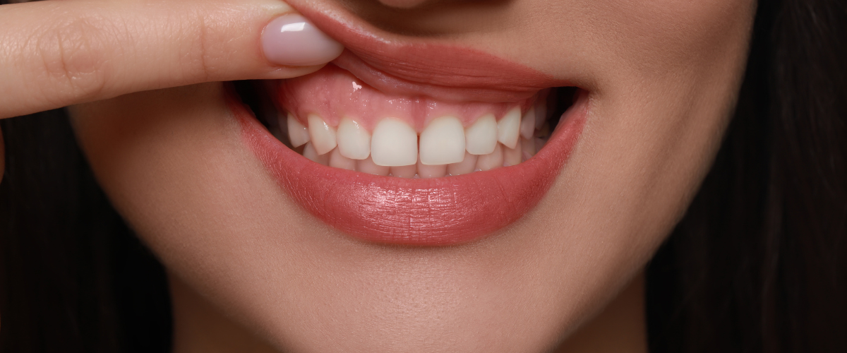 Help for Gummy Smiles