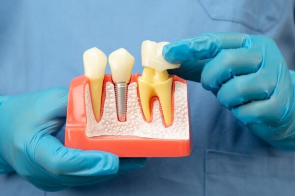 Dental Crowns in Singapore: Types, Procedure & Specialist Advice